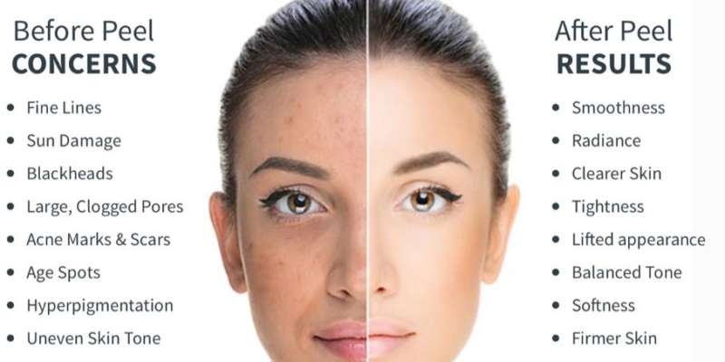 Chemical Peels treatments in Dubai | Facial Treatments Chemical Peels treatments in Dubai | Facial Treatments